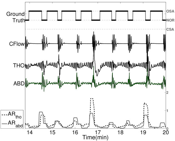 [1612.04185] Sleep Apnea Detection Based on Thoracic and Abdominal ...
