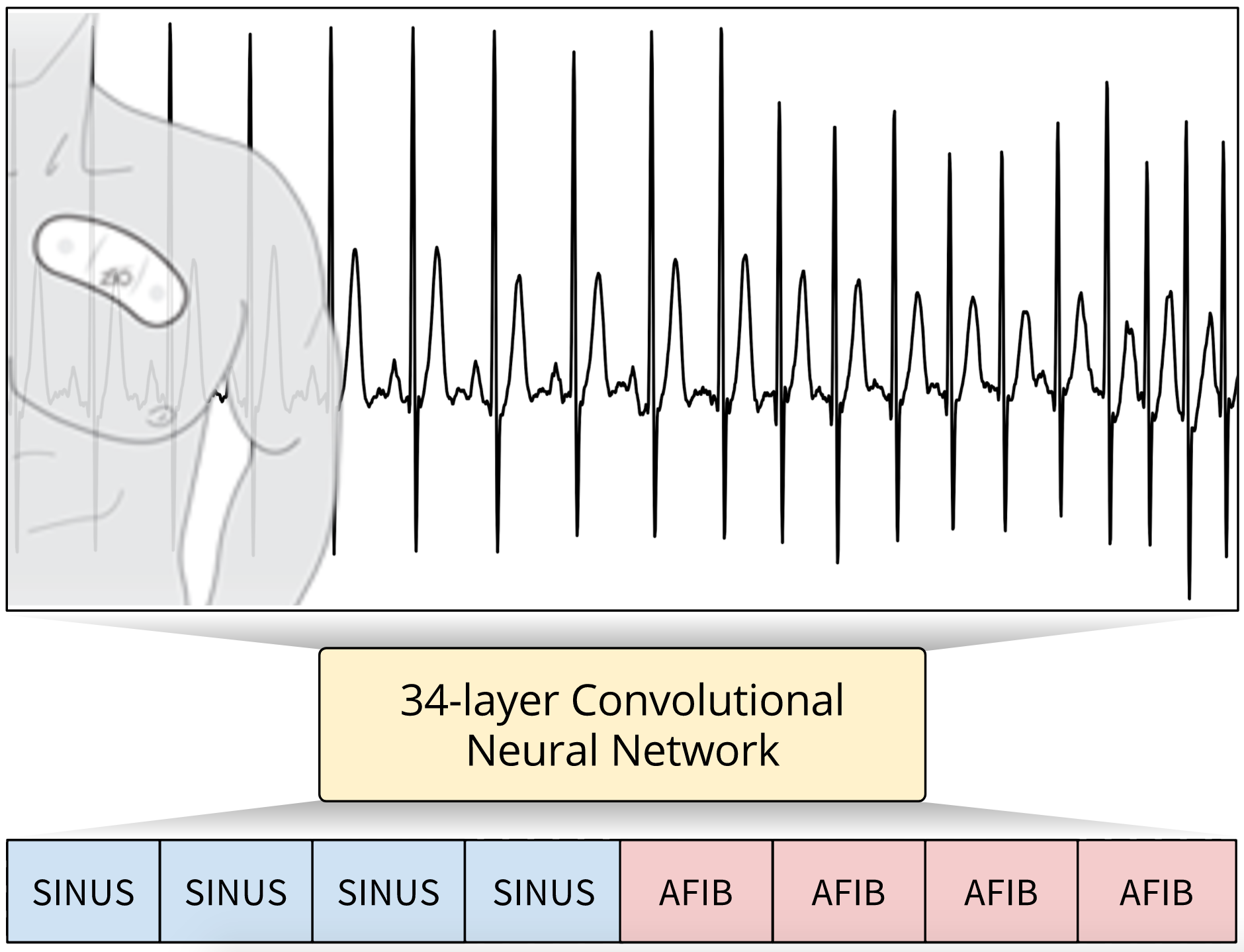 [1707.01836] Cardiologist-Level Arrhythmia Detection with Convolutional Neural Networks