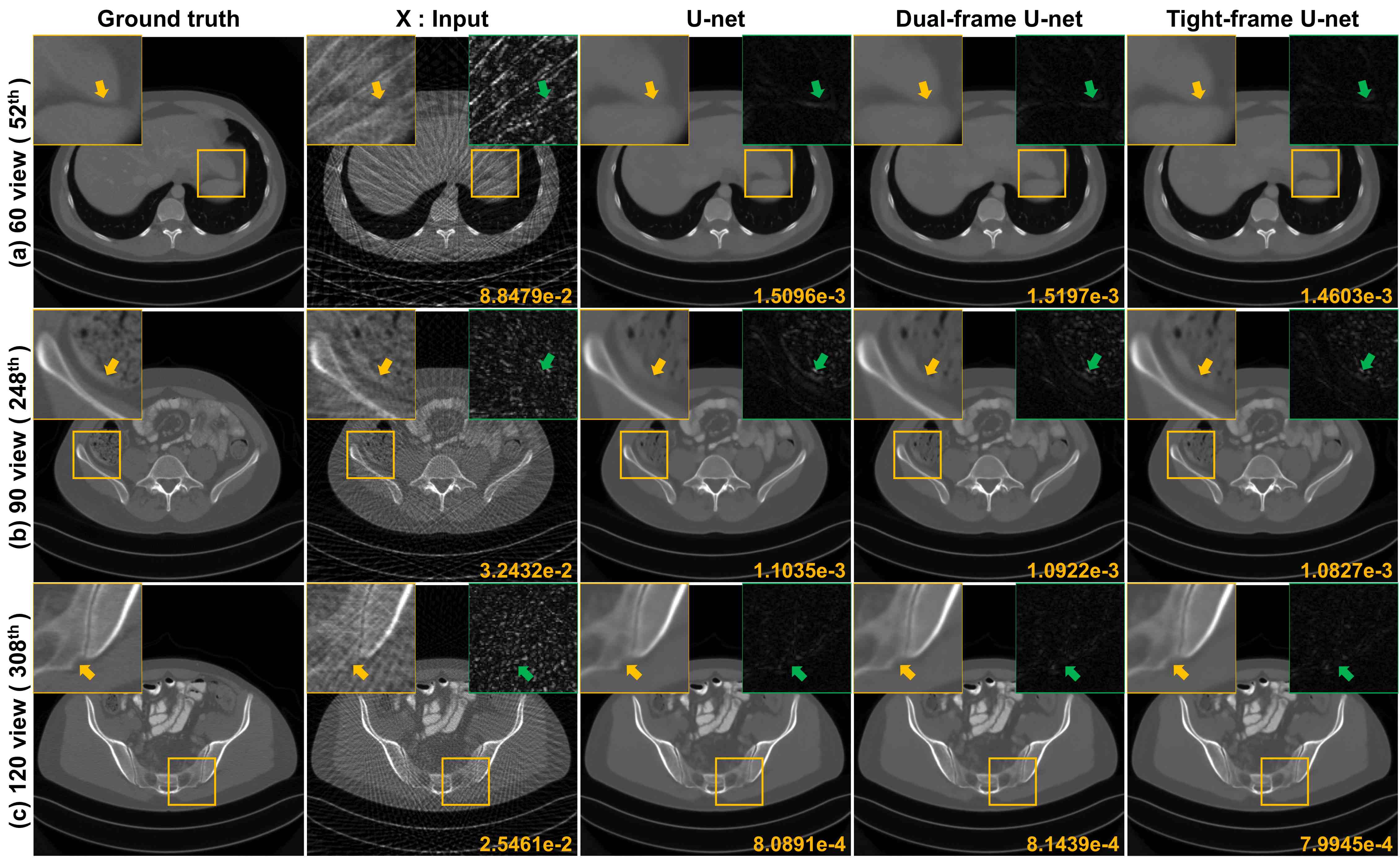 [1708.08333] Framing U-Net via Deep Convolutional Framelets: Application to Sparse-view CT