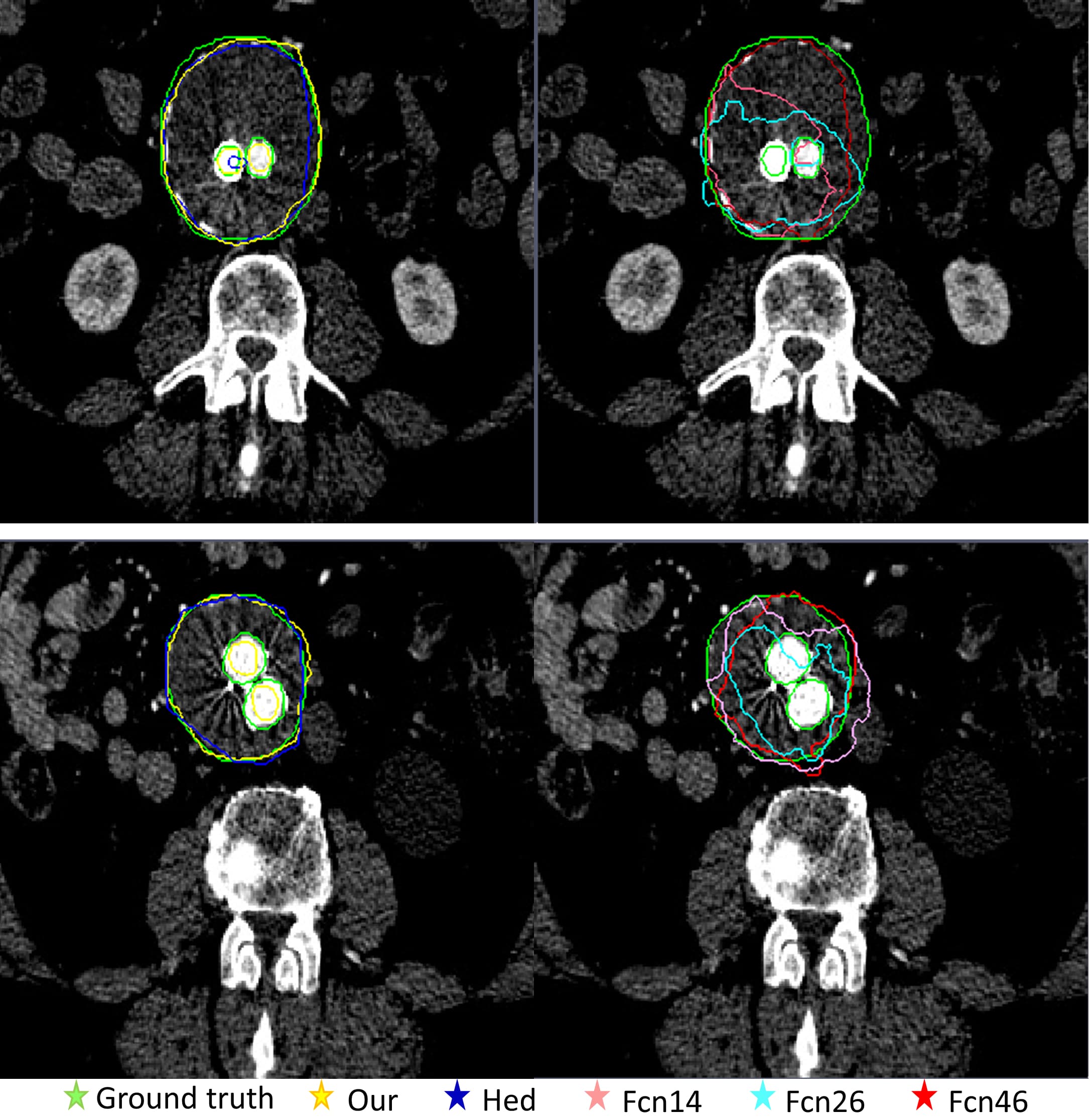 [1804.00304] Fully automatic detection and segmentation of abdominal aortic thrombus in post ...