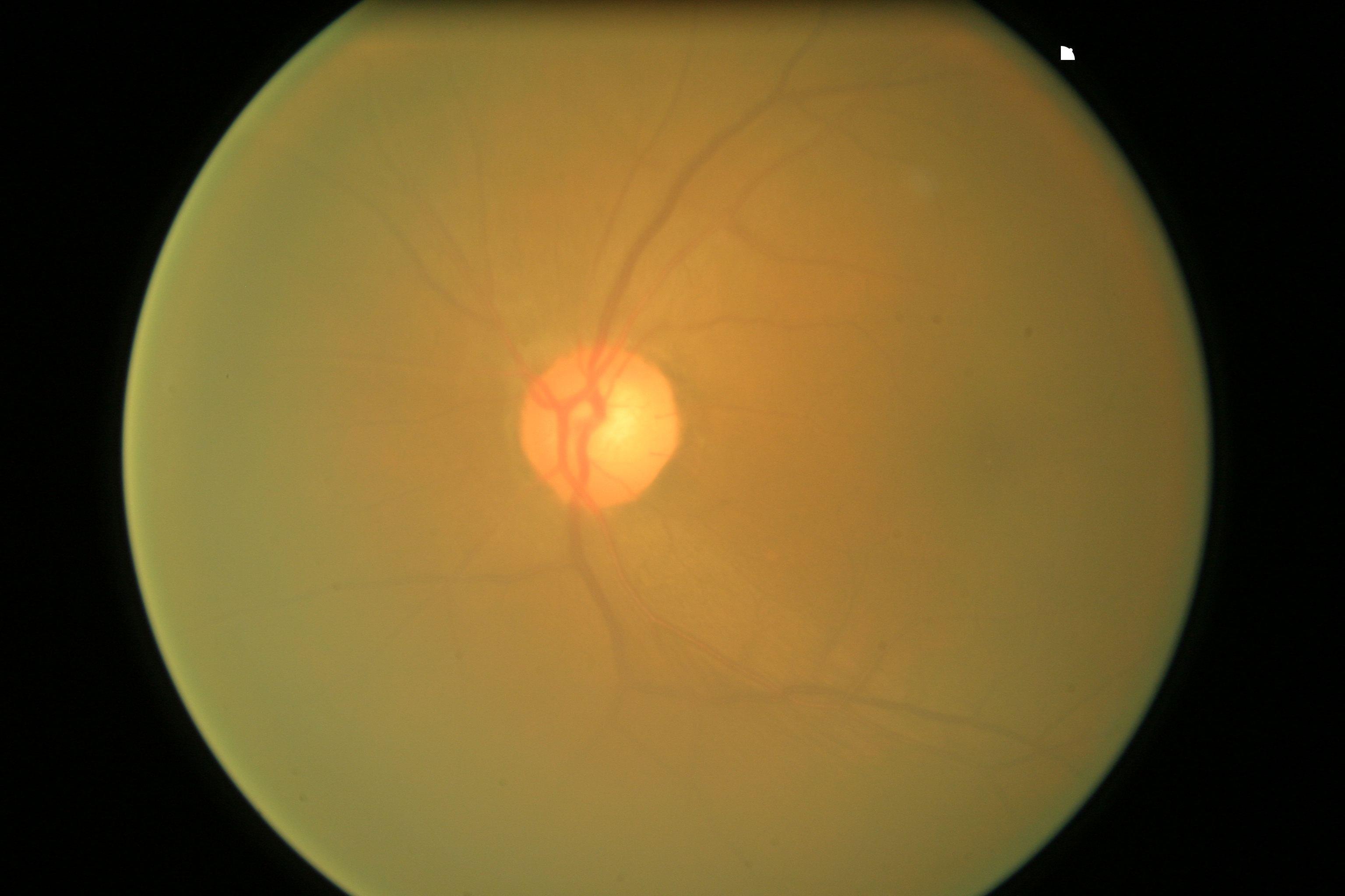 [1805.06625] Structure-preserving Guided Retinal Image Filtering and ...