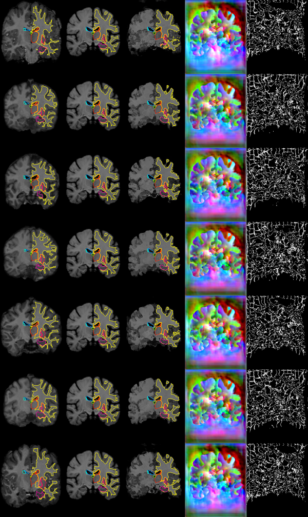 [1809.05231] VoxelMorph: A Learning Framework for Deformable Medical Image Registration