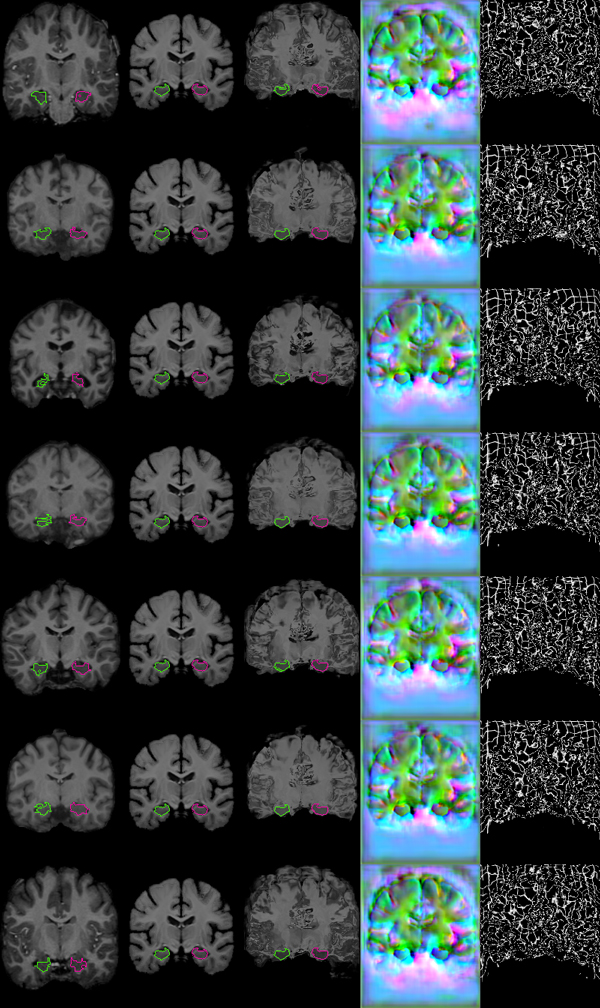 [1809.05231] VoxelMorph: A Learning Framework for Deformable Medical Image Registration