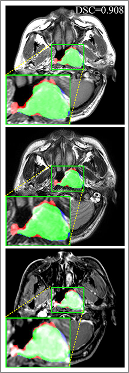 [1812.10033] MMFNet: A Multi-modality MRI Fusion Network for ...