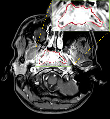 [1812.10033] MMFNet: A Multi-modality MRI Fusion Network for ...