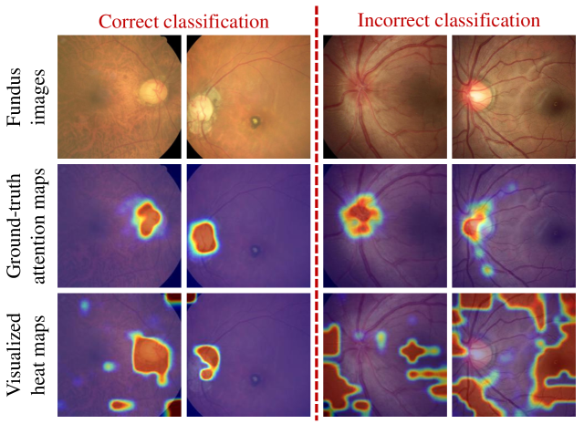 [1903.10831] Attention Based Glaucoma Detection: A Large-scale Database and CNN Model
