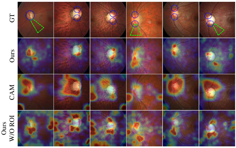 [1903.10831] Attention Based Glaucoma Detection: A Large-scale Database and CNN Model