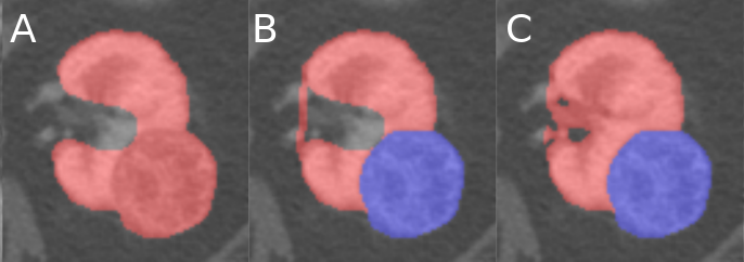 [1904.00445] The KiTS19 Challenge Data: 300 Kidney Tumor Cases with ...