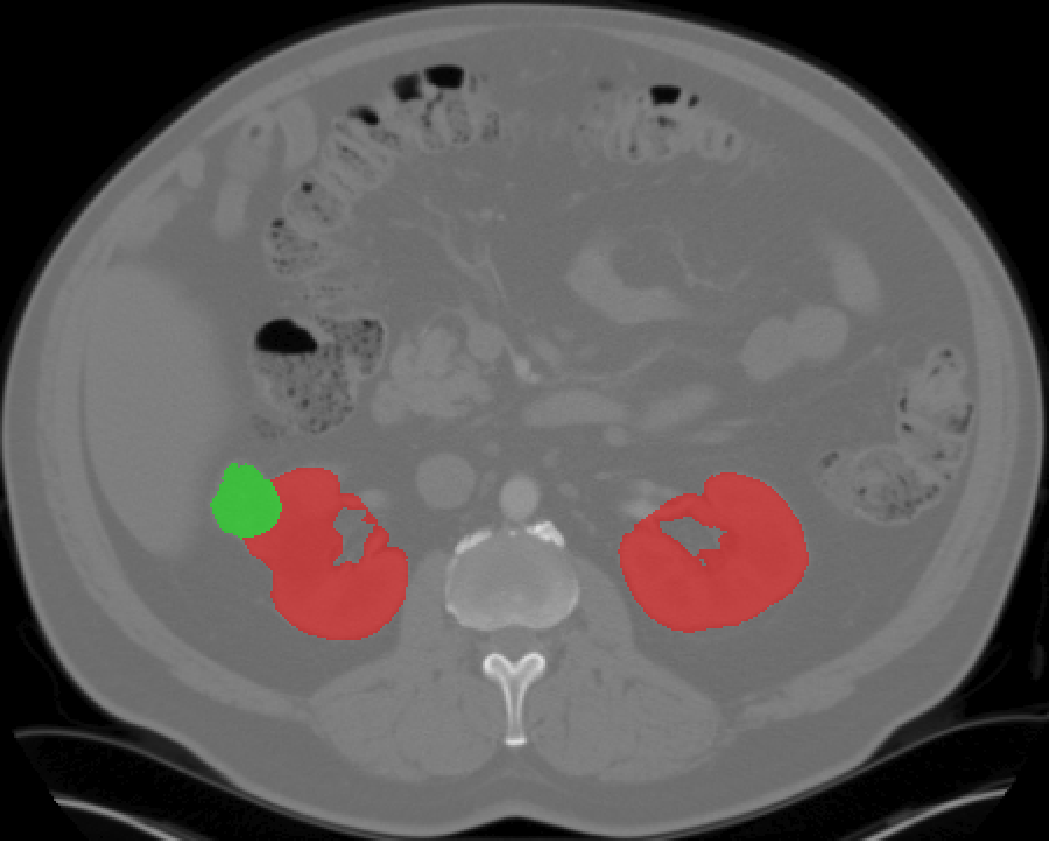 [1909.06684] 3D Kidneys and Kidney Tumor Semantic Segmentation using Boundary-Aware Networks