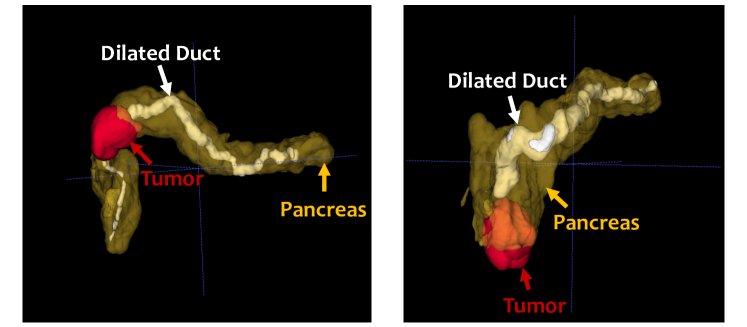 [1912.03383] Deep Distance Transform for Tubular Structure Segmentation in CT Scans