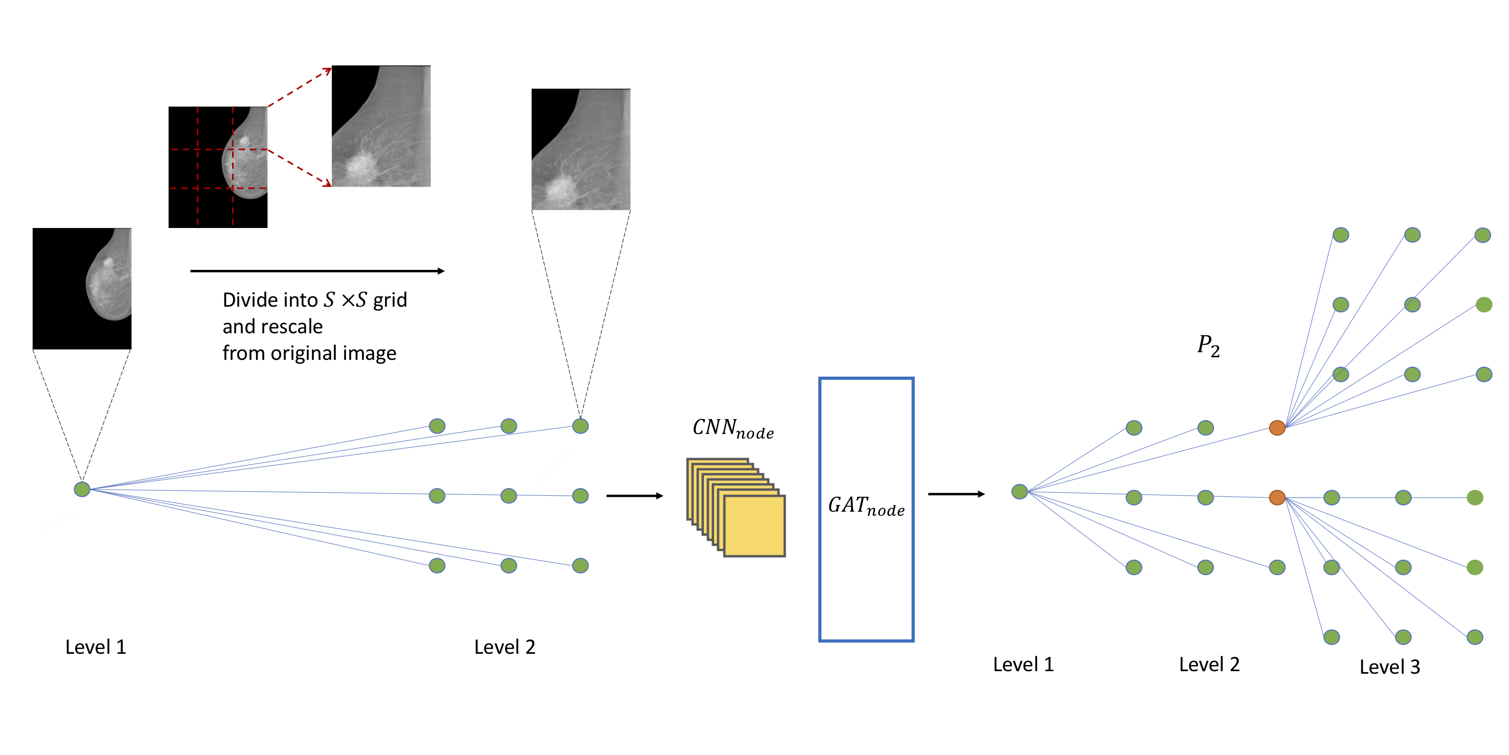 [1912.07517] Zoom in to where it matters: a hierarchical graph based model for mammogram analysis