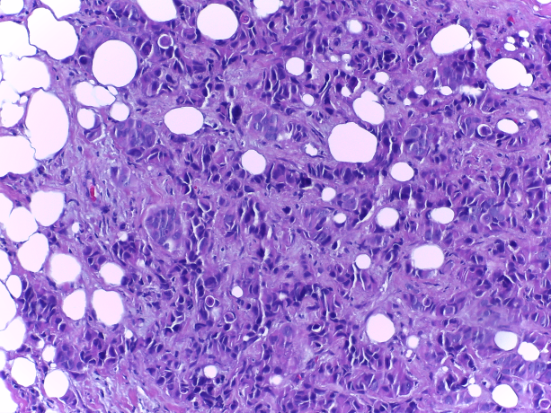 [2003.00823] Breast Cancer Histopathology Image Classification and ...