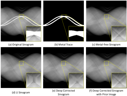 [2009.07469] Deep Sinogram Completion with Image Prior for Metal ...