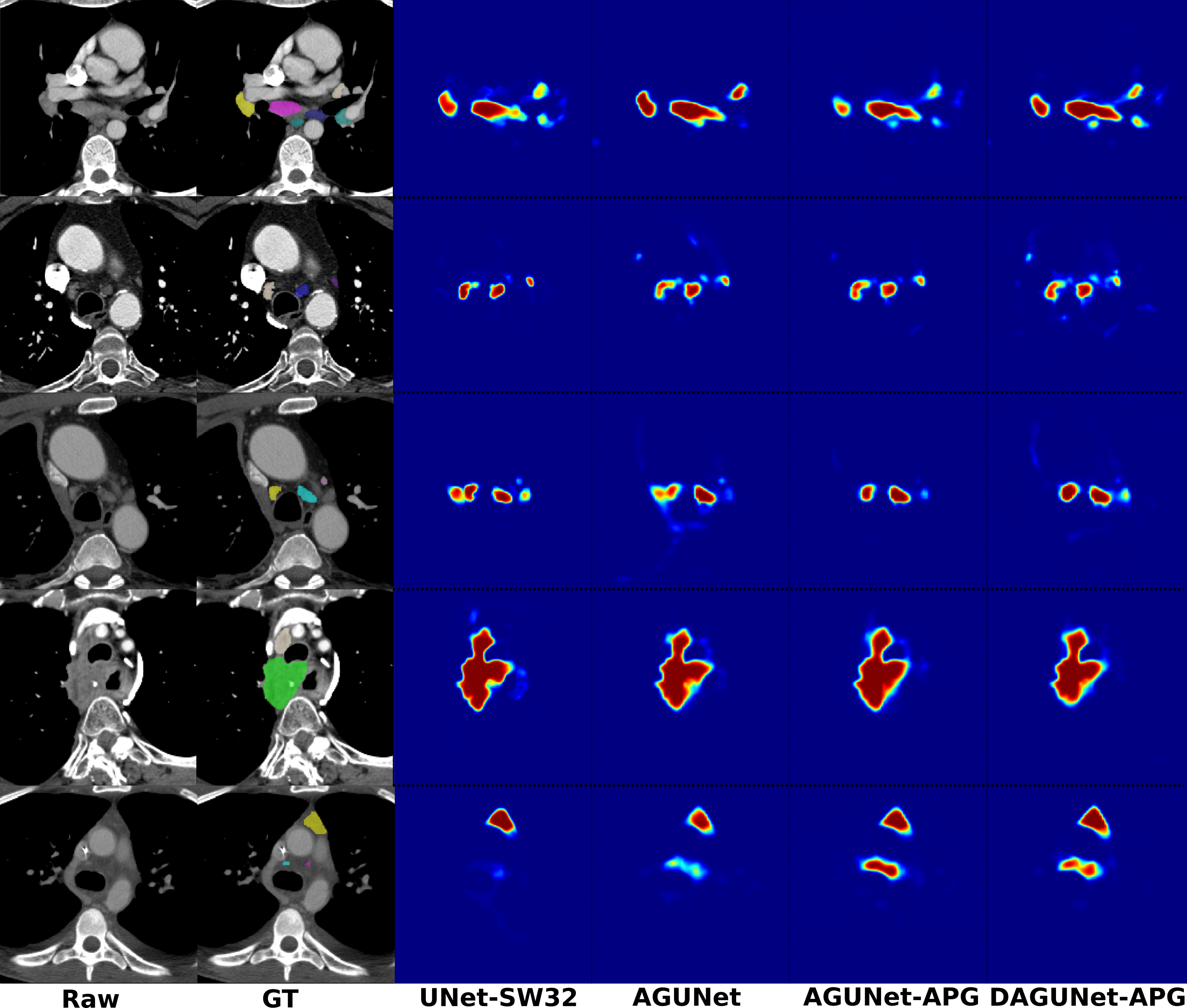 [2102.06515] Mediastinal lymph nodes segmentation using 3D convolutional neural network ...