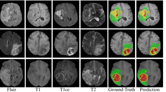 [2104.00985] Brain Tumor Segmentation and Survival Prediction using 3D Attention UNet