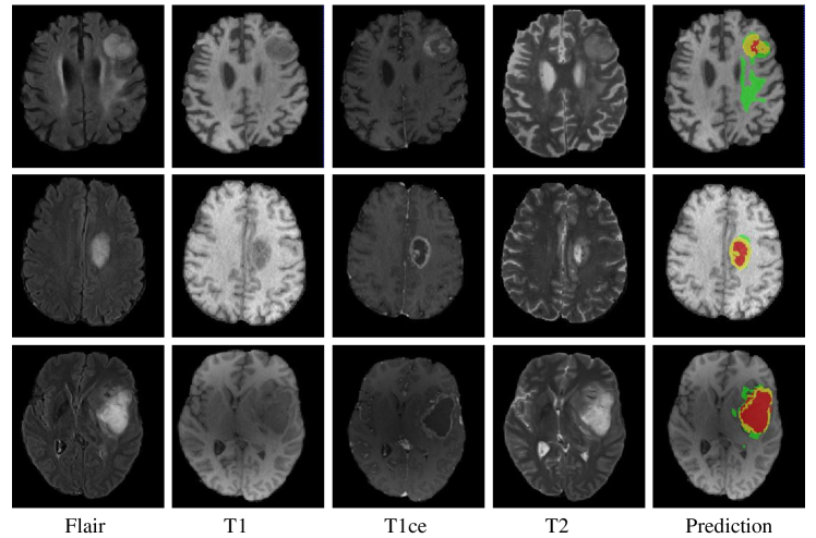 [2104.00985] Brain Tumor Segmentation and Survival Prediction using 3D Attention UNet