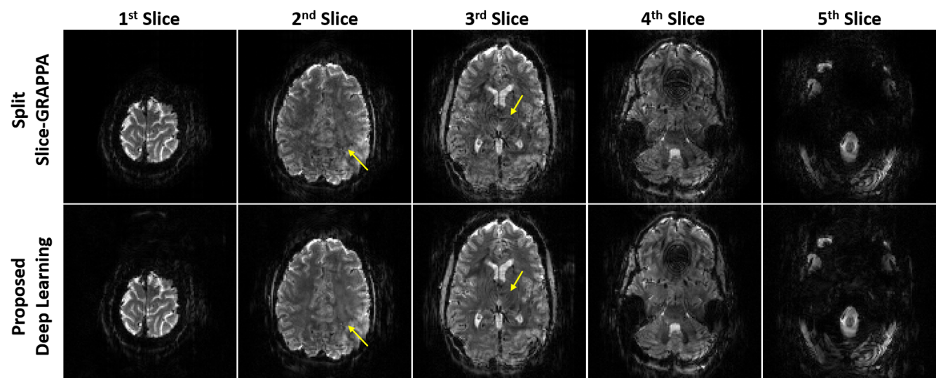 [2105.04532] Improved Simultaneous Multi-Slice Functional MRI Using Self-supervised Deep Learning