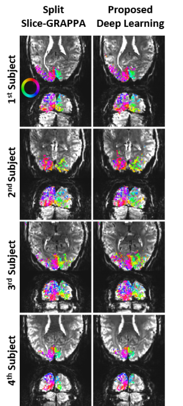 [2105.04532] Improved Simultaneous Multi-Slice Functional MRI Using Self-supervised Deep Learning
