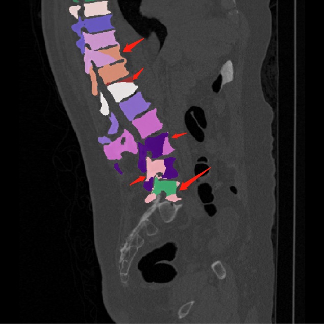 [2105.14711] CTSpine1K: A Large-Scale Dataset for Spinal Vertebrae ...