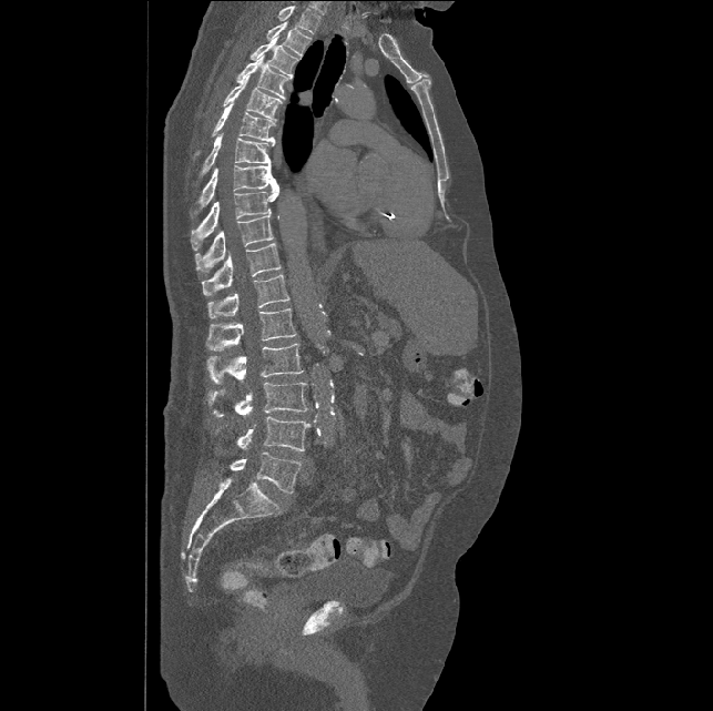 [2105.14711] CTSpine1K: A Large-Scale Dataset for Spinal Vertebrae ...