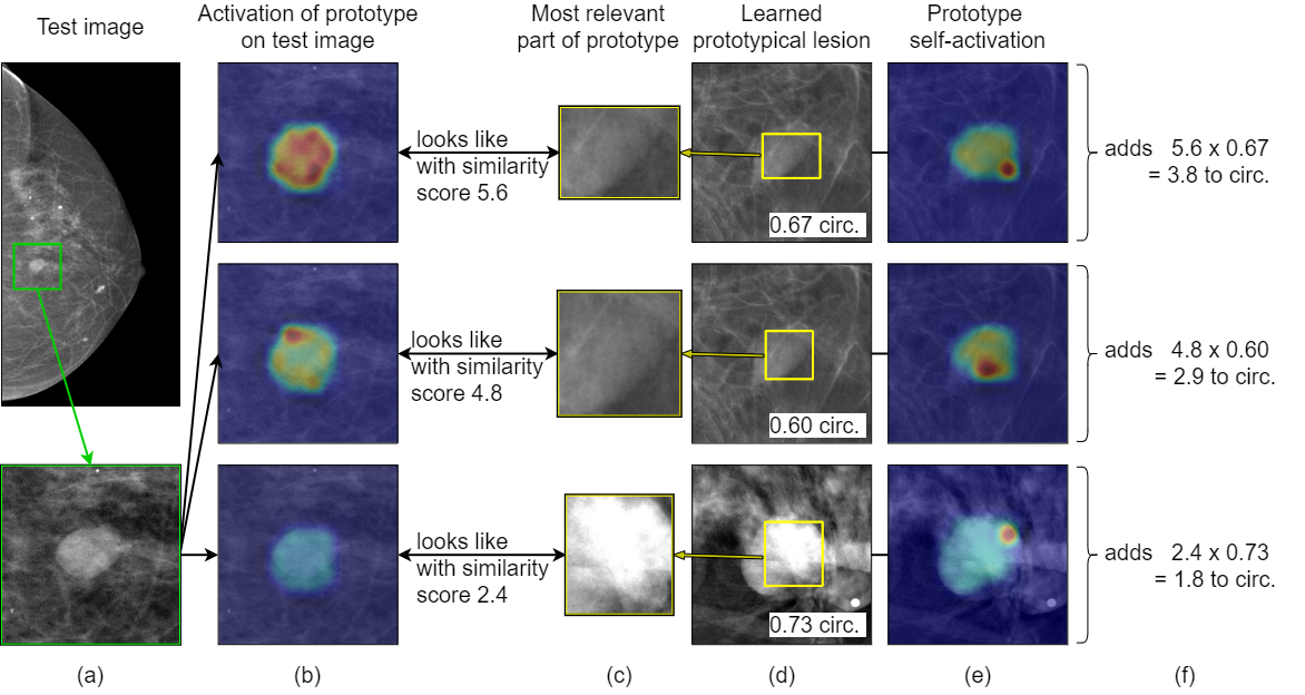 [2107.05605] Interpretable Mammographic Image Classification using Case-Based Reasoning and Deep ...
