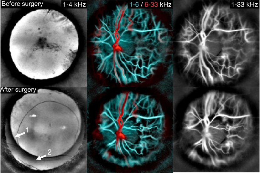 [2107.10799] Laser Doppler holography of the anterior segment for blood ...