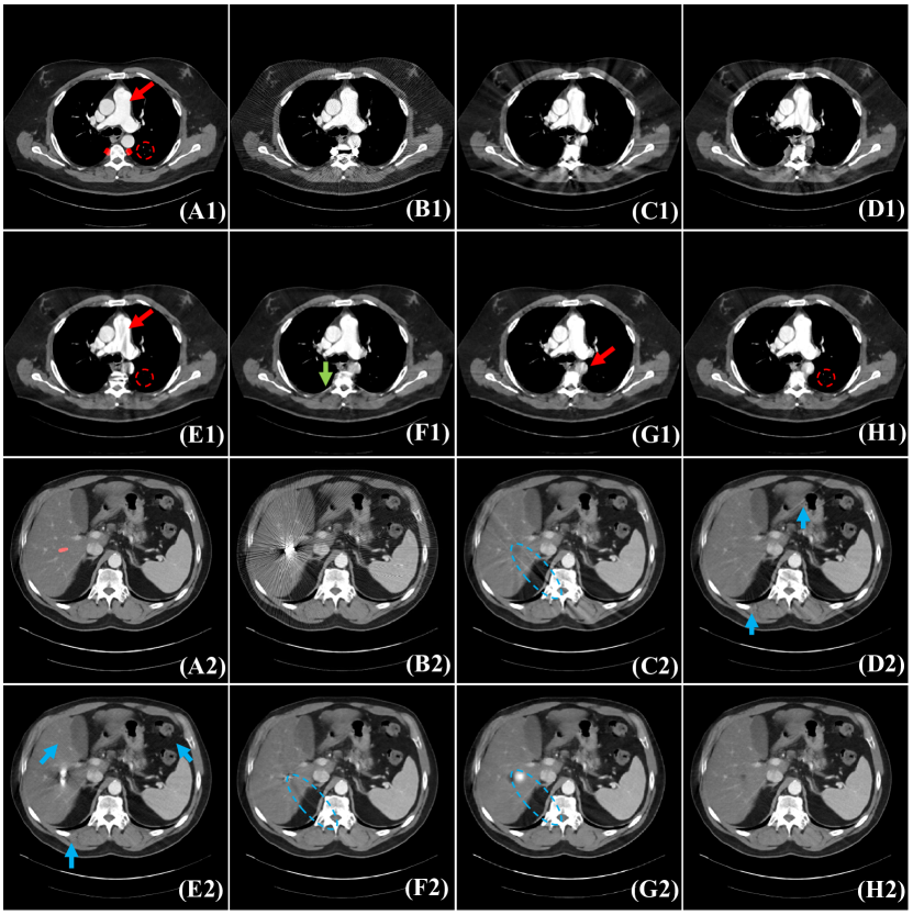 [2109 13483] Metal Artifact Reduction In 2d Ct Images With Self Supervised Cross Domain Learning