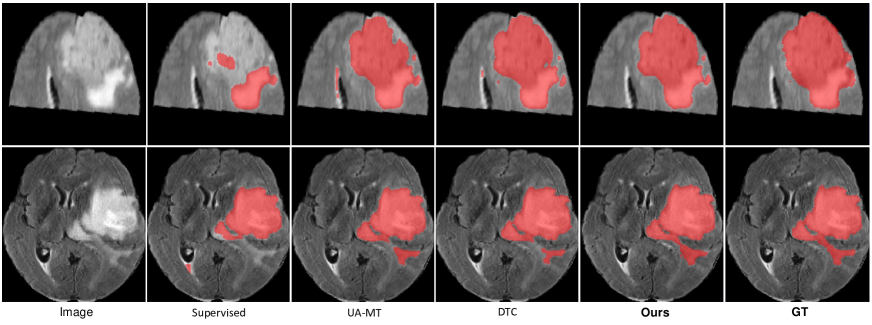 [2112.02508] Uncertainty-Guided Mutual Consistency Learning for Semi-Supervised Medical Image ...