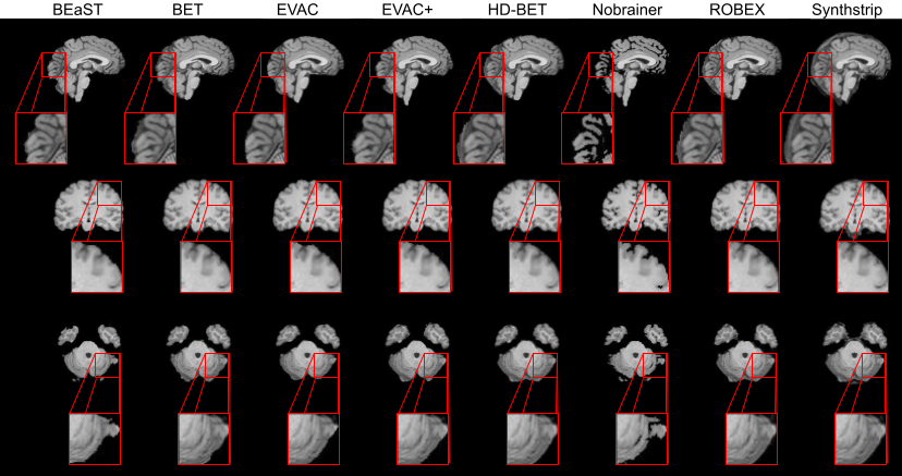 [2206.02837] EVAC+: Multi-scale V-net with Deep Feature CRF Layers for Brain Extraction