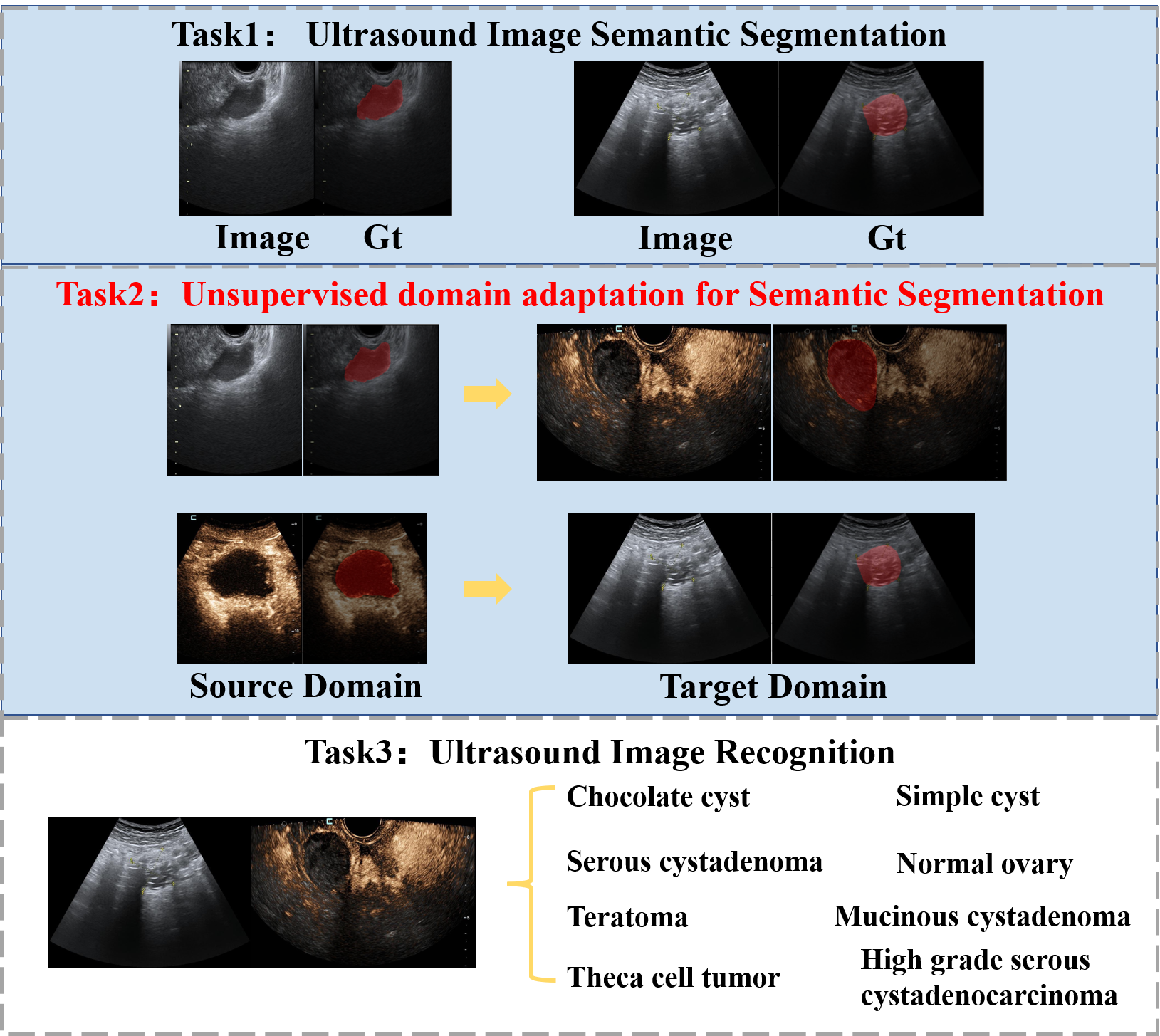 [2207.06799] MMOTU: A Multi-Modality Ovarian Tumor Ultrasound Image ...