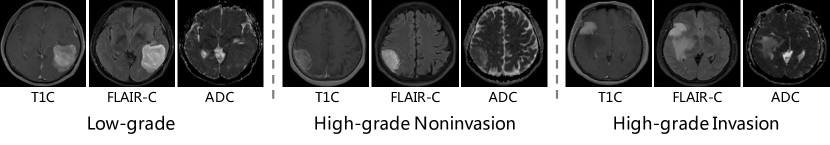 [2209.01517] Joint Prediction of Meningioma Grade and Brain Invasion ...