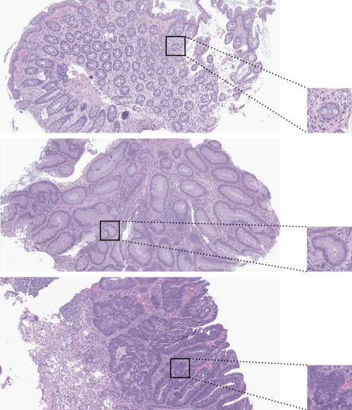 [2301.02608] A CAD System for Colorectal Cancer from WSI: A Clinically ...
