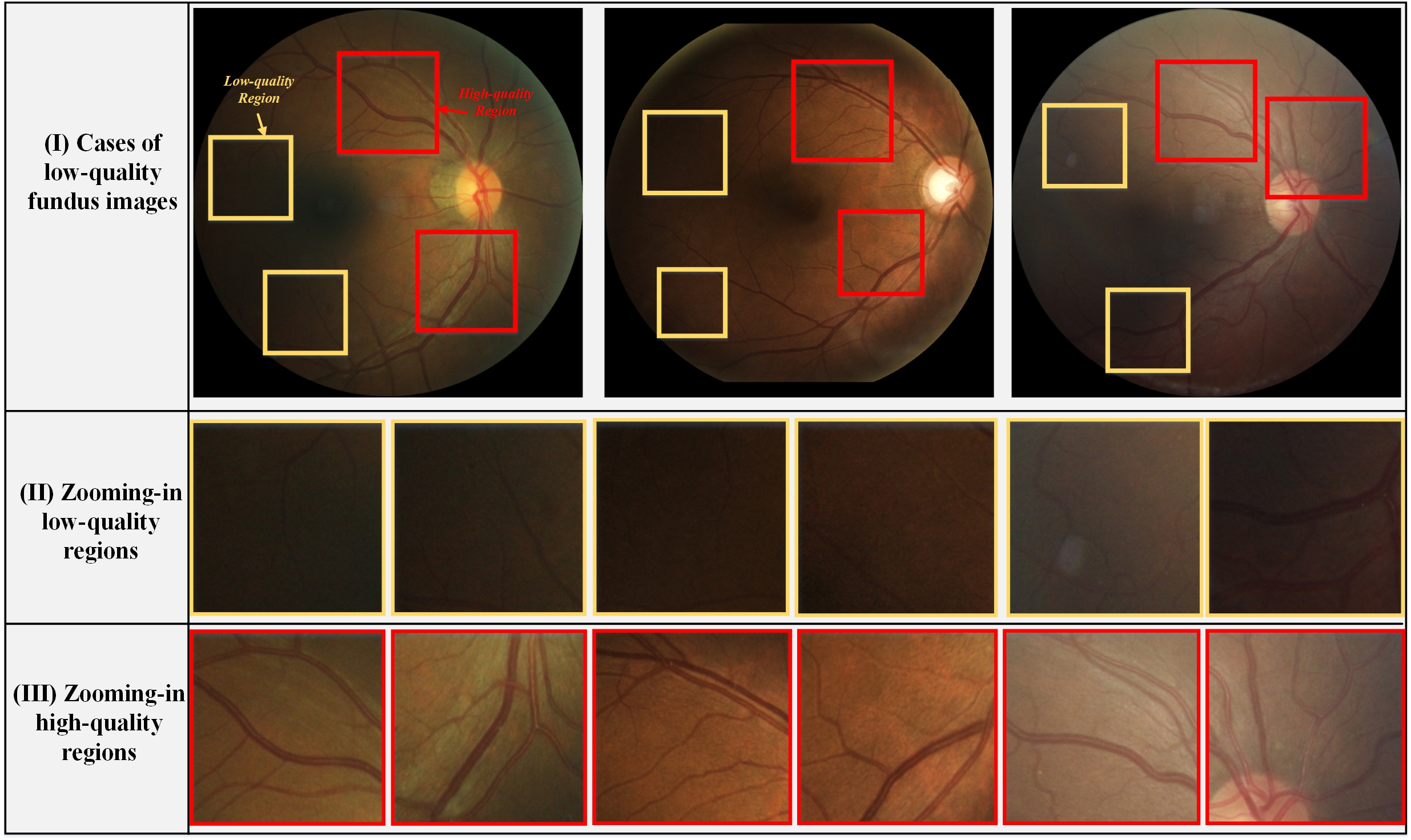 [2301.06943] Self-supervised Domain Adaptation for Breaking the Limits of Low-quality Fundus ...