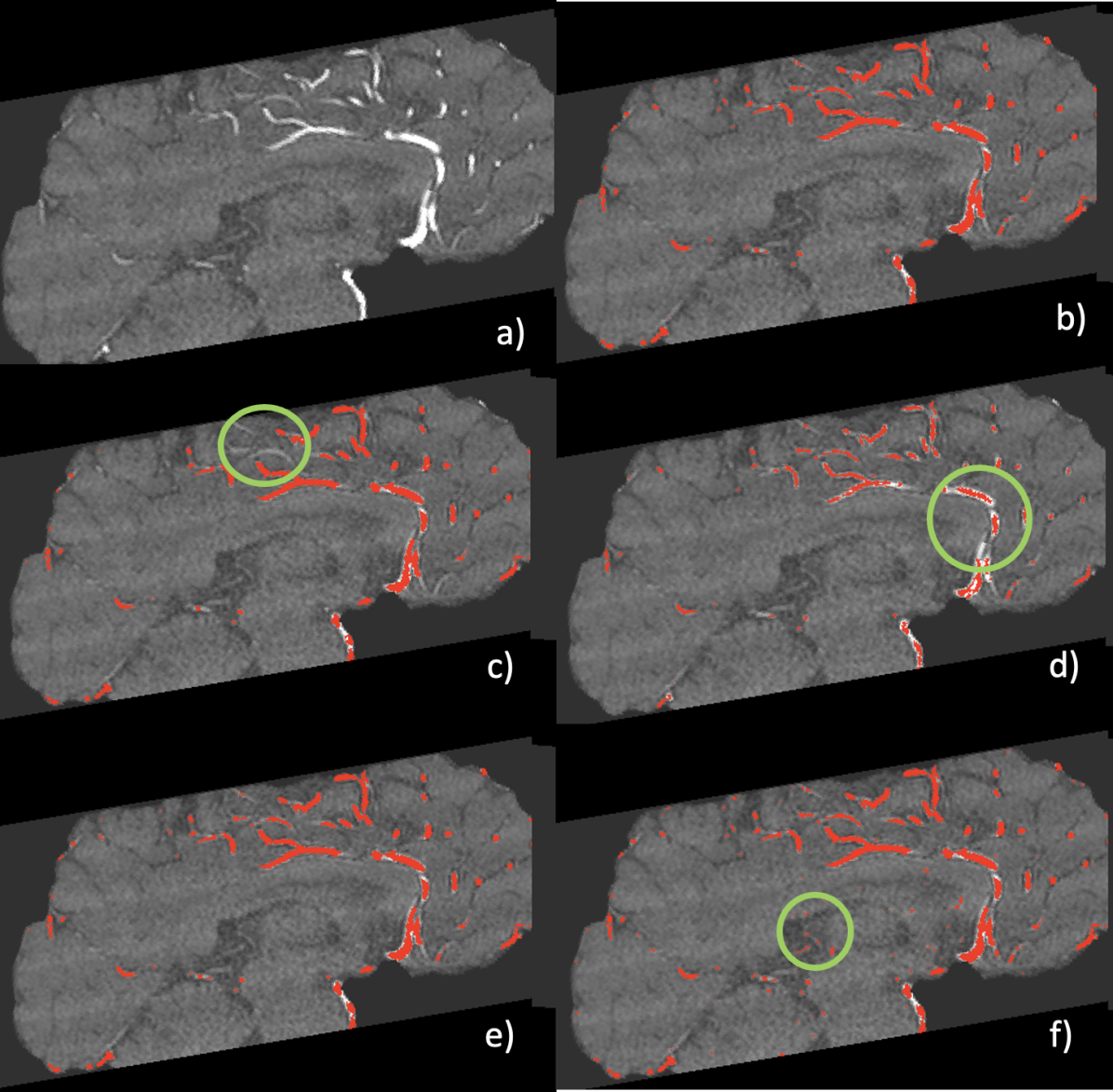 [2303.05113] Segmentation method for cerebral blood vessels from MRA ...