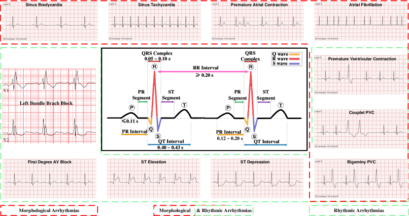 [2304.04646] ECG-CL: A Comprehensive Electrocardiogram Interpretation ...