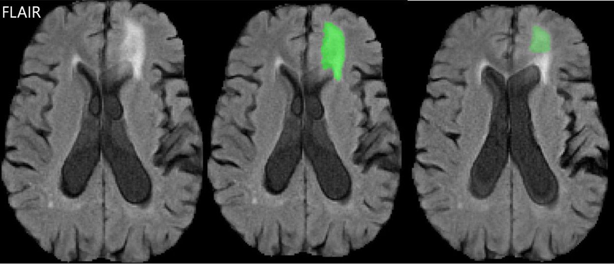 [2305.07642] The ASNR-MICCAI Brain Tumor Segmentation (BraTS) Challenge 2023: Intracranial ...