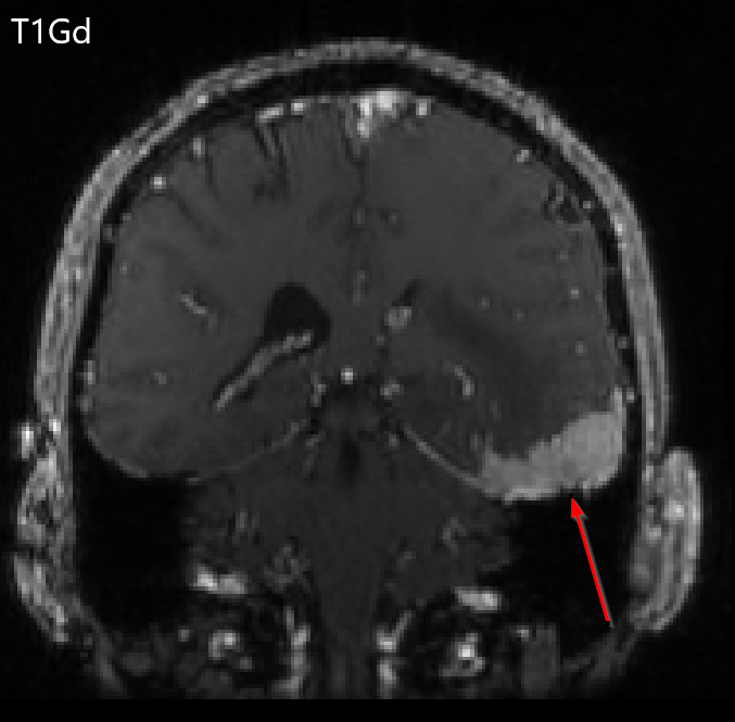 [2305.07642] The ASNR-MICCAI Brain Tumor Segmentation (BraTS) Challenge 2023: Intracranial ...