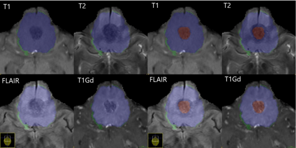 [2305.07642] The ASNR-MICCAI Brain Tumor Segmentation (BraTS) Challenge 2023: Intracranial ...