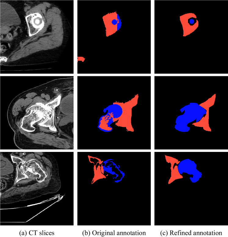 [2306.04579] A Dataset for Deep Learning-based Bone Structure Analyses ...