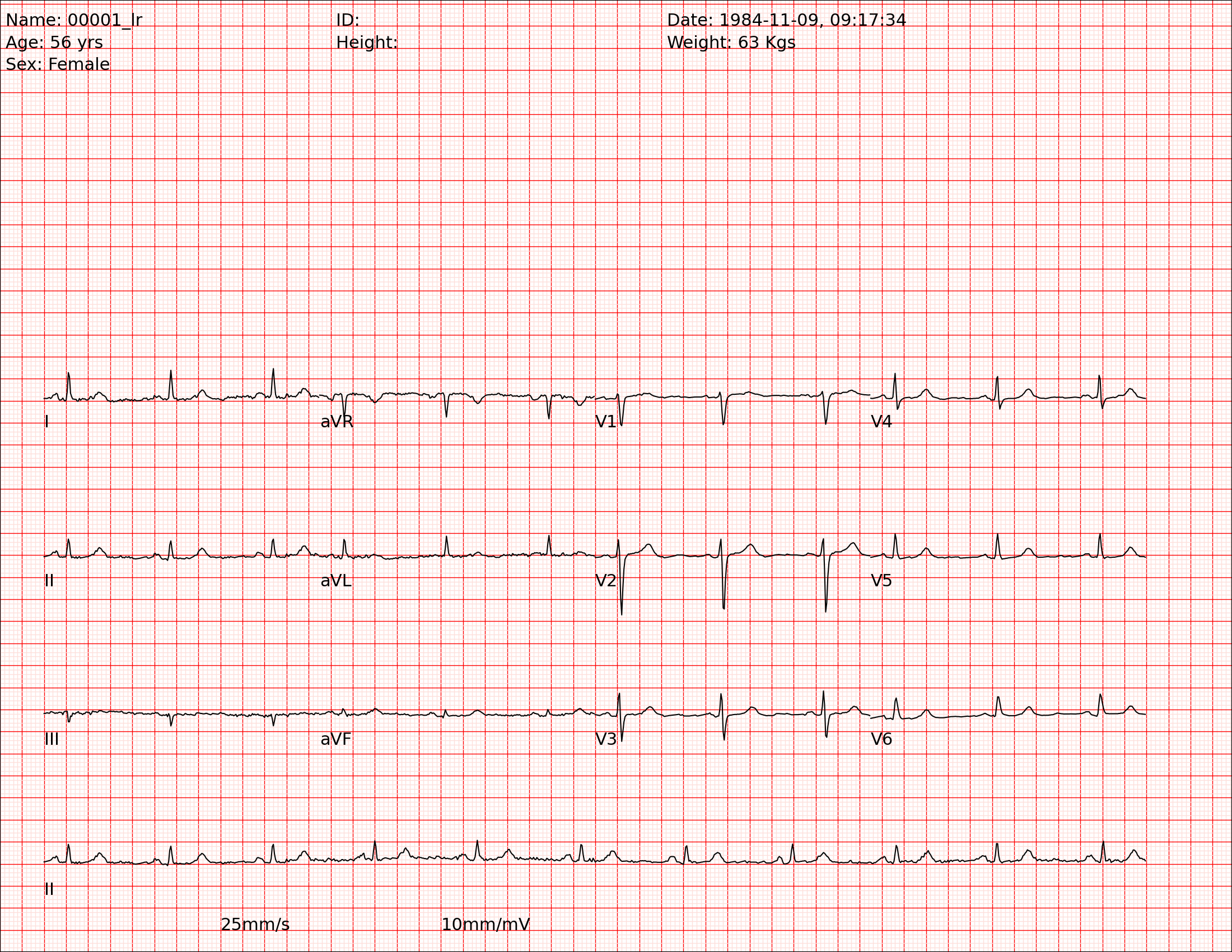 [2307.01946] ECG-Image-Kit: A Synthetic Image Generation Toolbox to ...