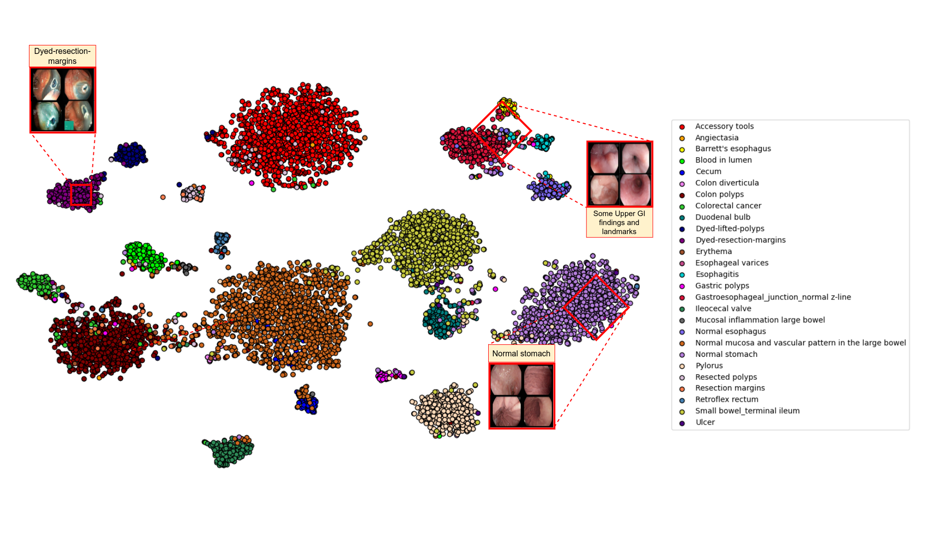 [2307.08140] GastroVision: A Multi-class Endoscopy Image Dataset for ...