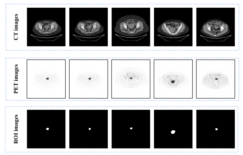 [2308.08313] ECPC-IDS:A benchmark endometrial cancer PET/CT image dataset for evaluation of ...