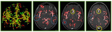 [2308.14626] VesselShot: Few-shot learning for cerebral blood vessel ...