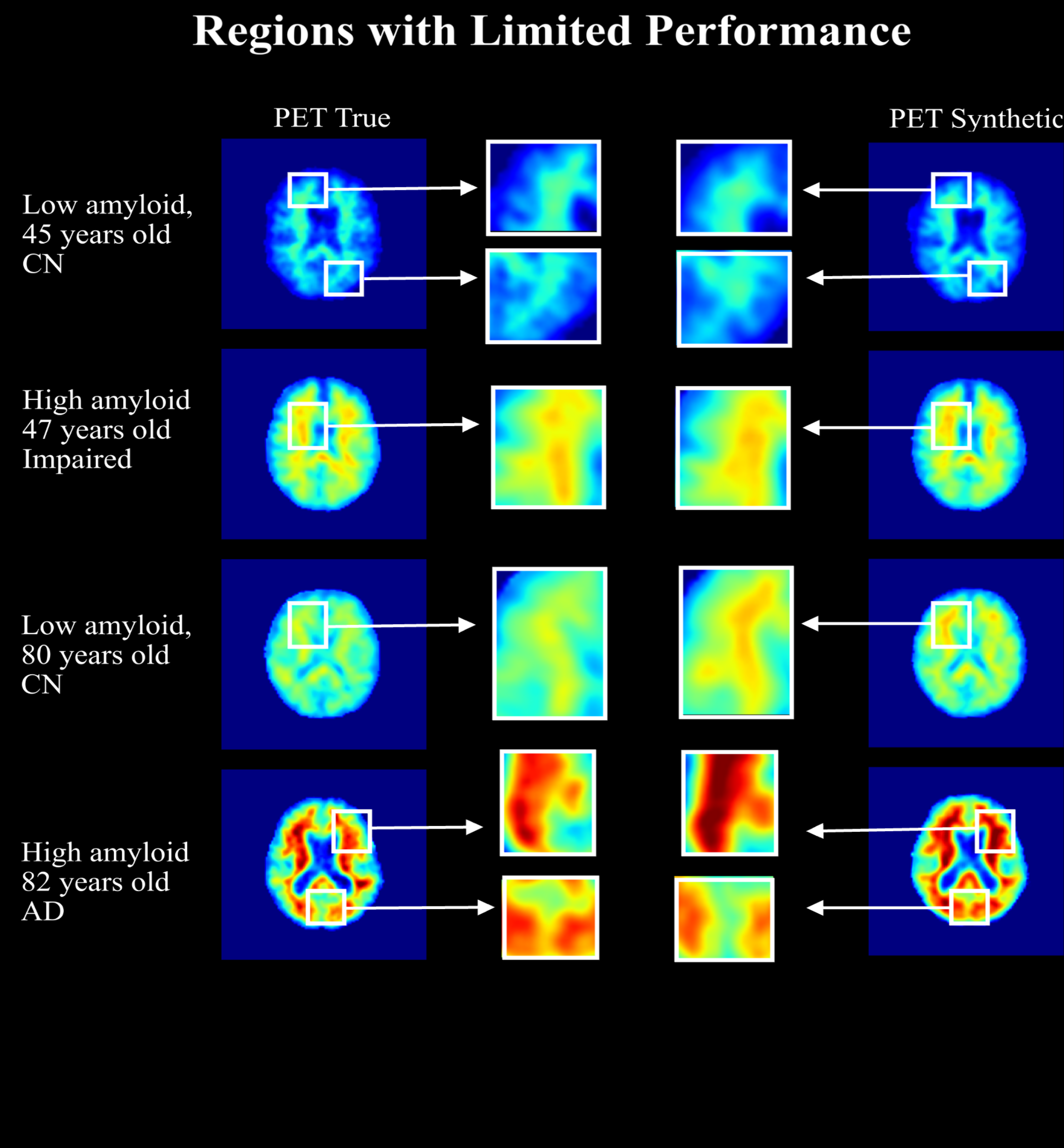 [2309.00569] Amyloid-Beta Axial Plane PET Synthesis from Structural MRI ...