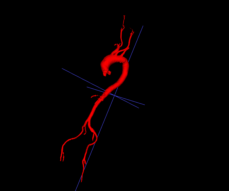 [2310.04114] Aorta Segmentation from 3D CT in MICCAI SEG.A. 2023 Challenge.