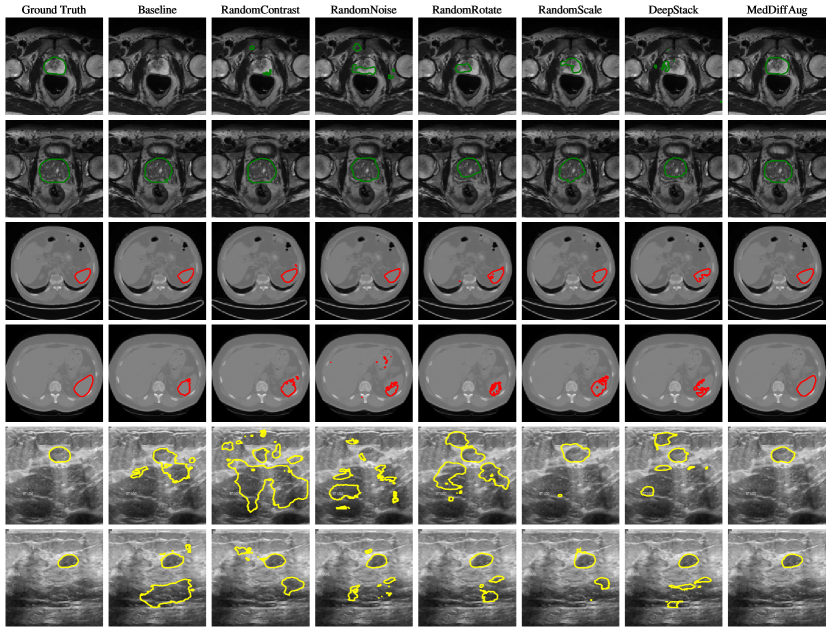 [2310.12868] EMIT-Diff: Enhancing Medical Image Segmentation via Text-Guided Diffusion Model