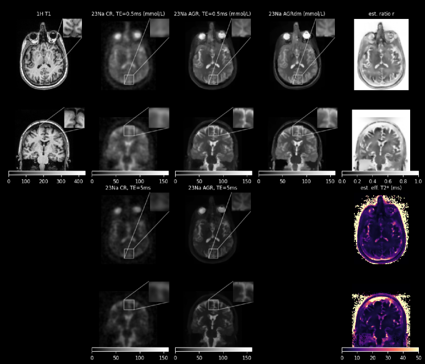 [2311.03116] Resolution enhancement, noise suppression, and joint T2* decay estimation in dual ...