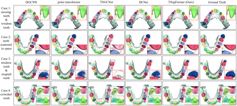 [2311.13234] TSegFormer: 3D Tooth Segmentation in Intraoral Scans with ...