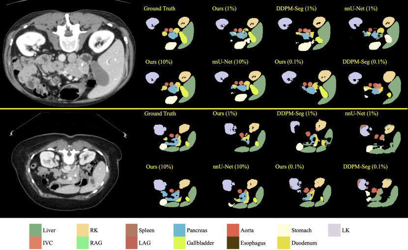 [2402.15216] Label-efficient Multi-organ Segmentation Method with Diffusion Model