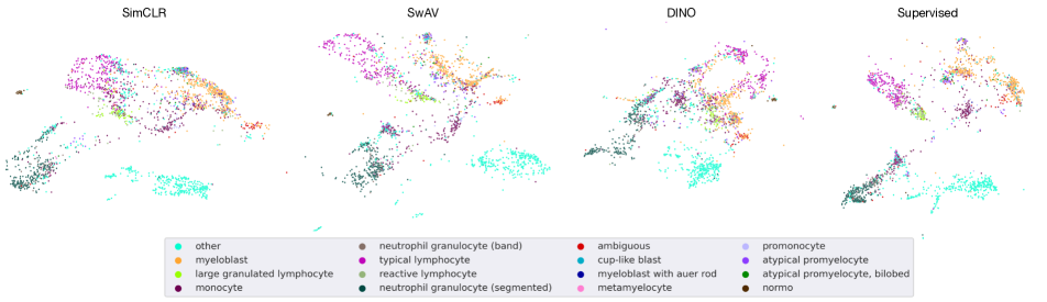 [2403.05379] Self-Supervised Multiple Instance Learning for Acute Myeloid Leukemia Classification